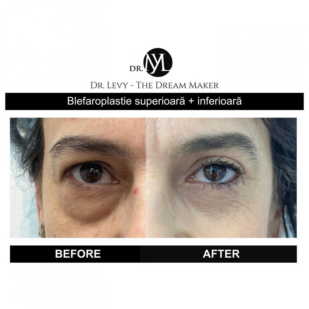 +Poze operatie Blefaroplastie (superioara & inferioara)