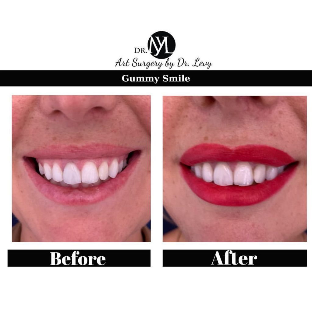 +Poze operatie Gummy Smile - before & after