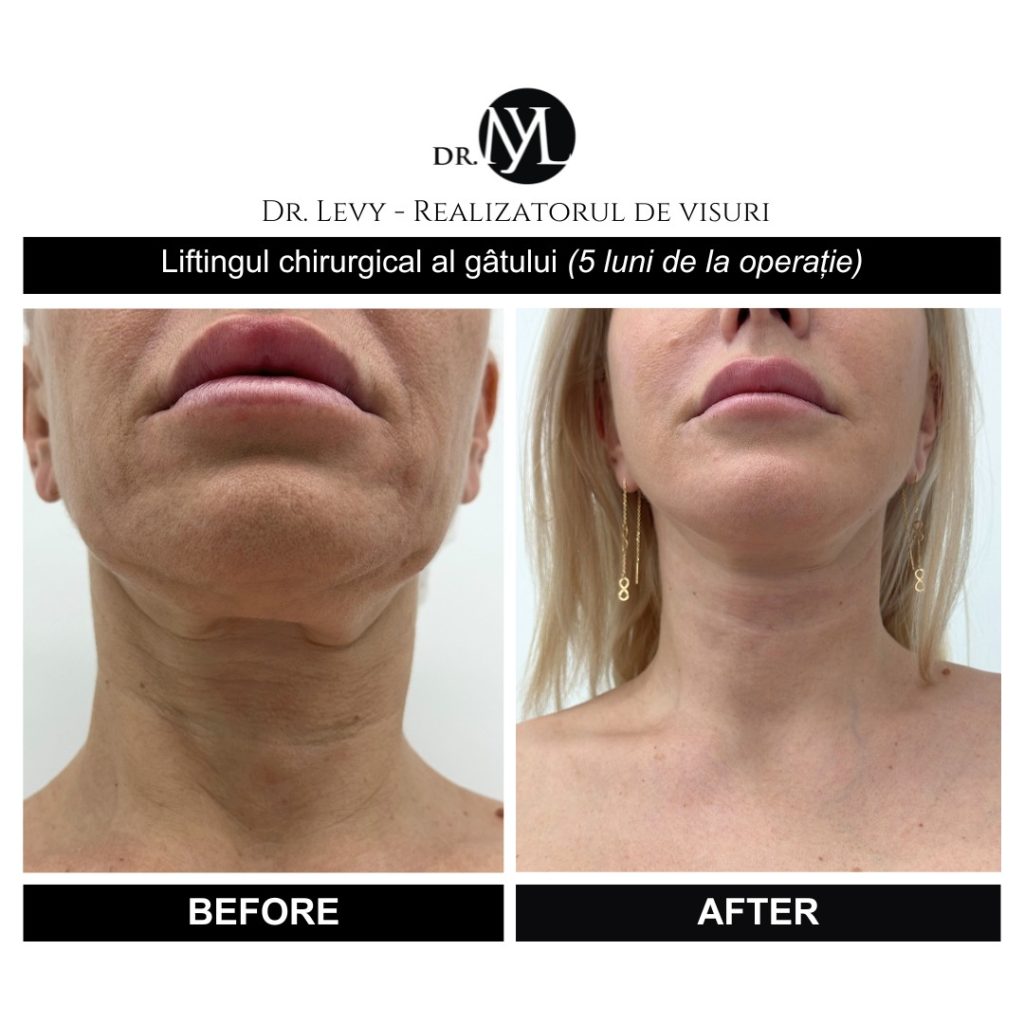 +Poze operatie Lifting Facial - inainte & dupa